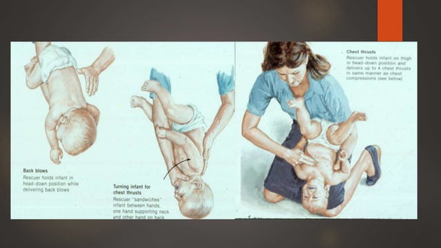 Foreign body aspiration in children | PPTX