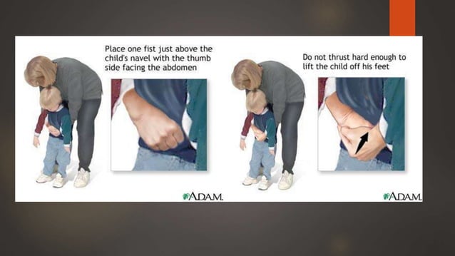 Foreign body aspiration in children