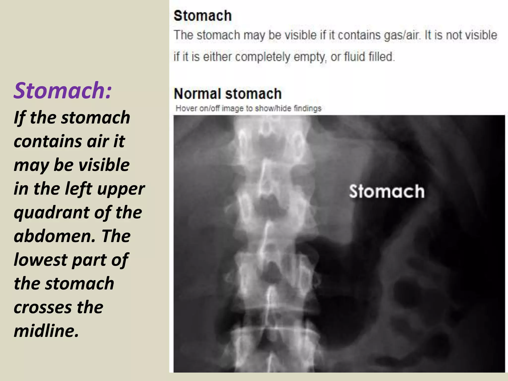 Presentation1, interpretation of x ray of the abdomen. | PPTX