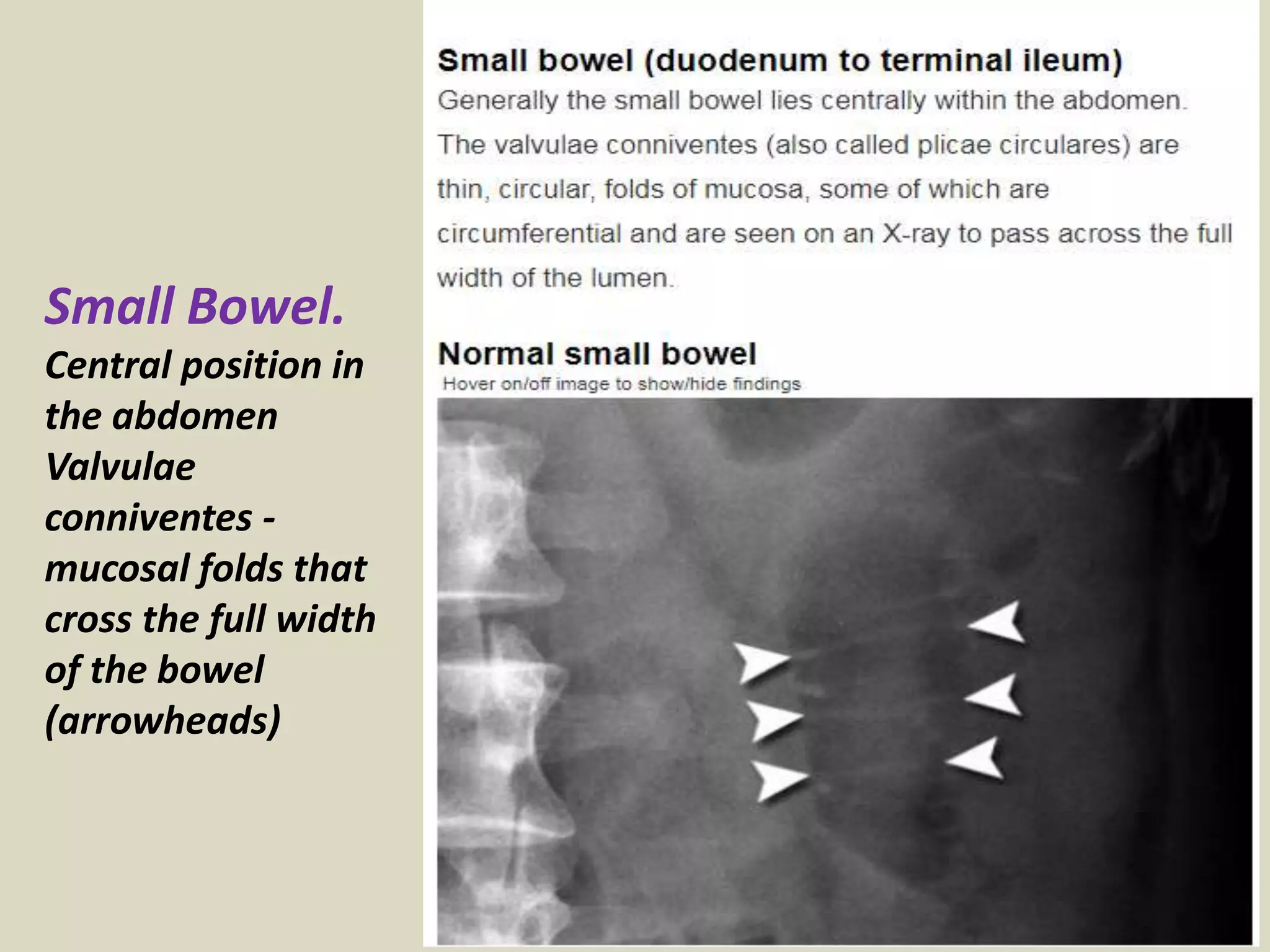 Presentation1, interpretation of x ray of the abdomen. | PPTX