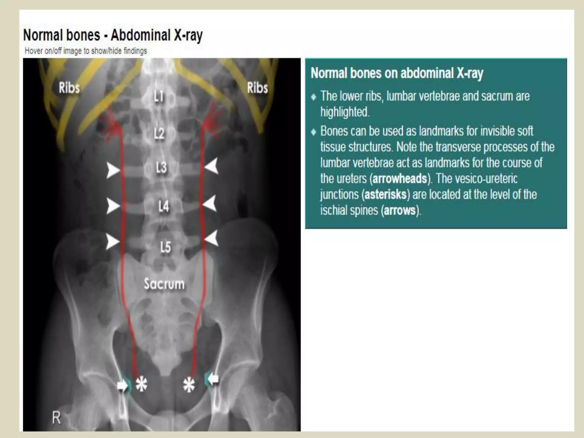 Presentation1, interpretation of x ray of the abdomen. | PPTX