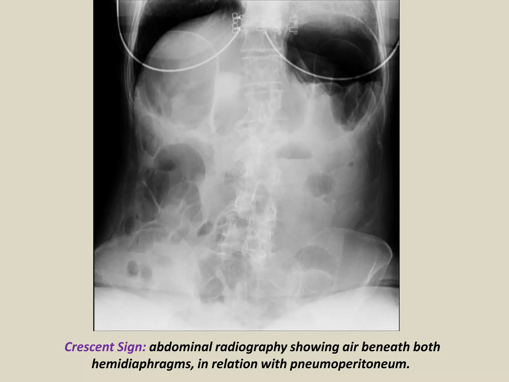 Presentation1, interpretation of x ray of the abdomen. | PPTX