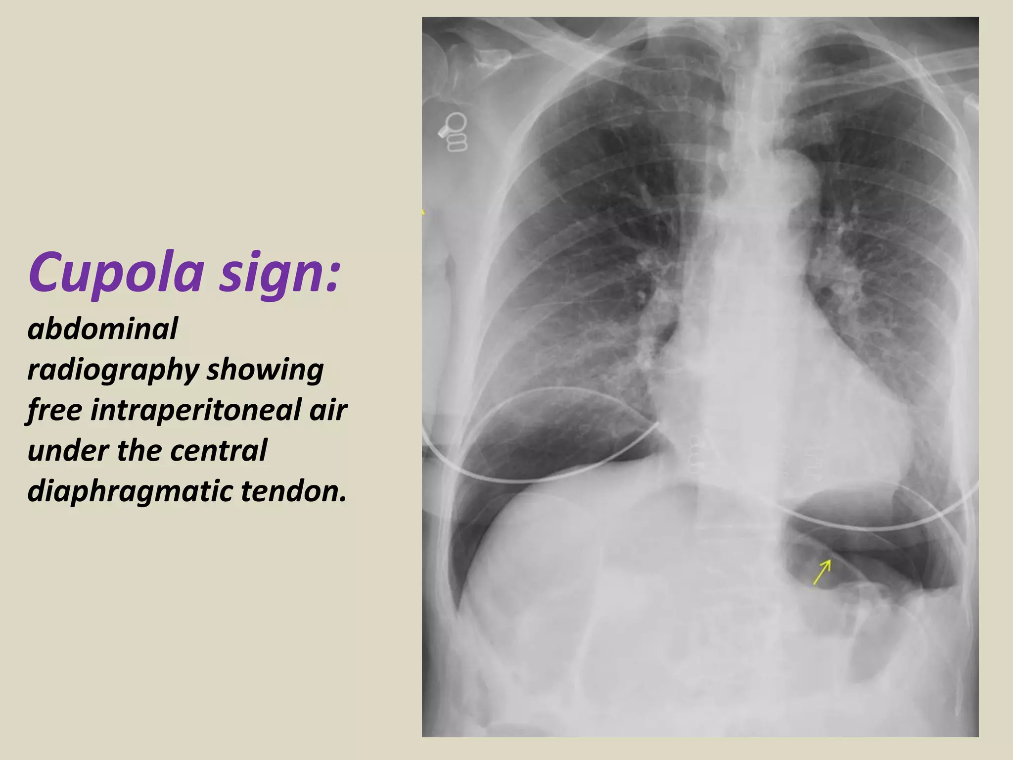 Presentation1, interpretation of x ray of the abdomen. | PPTX