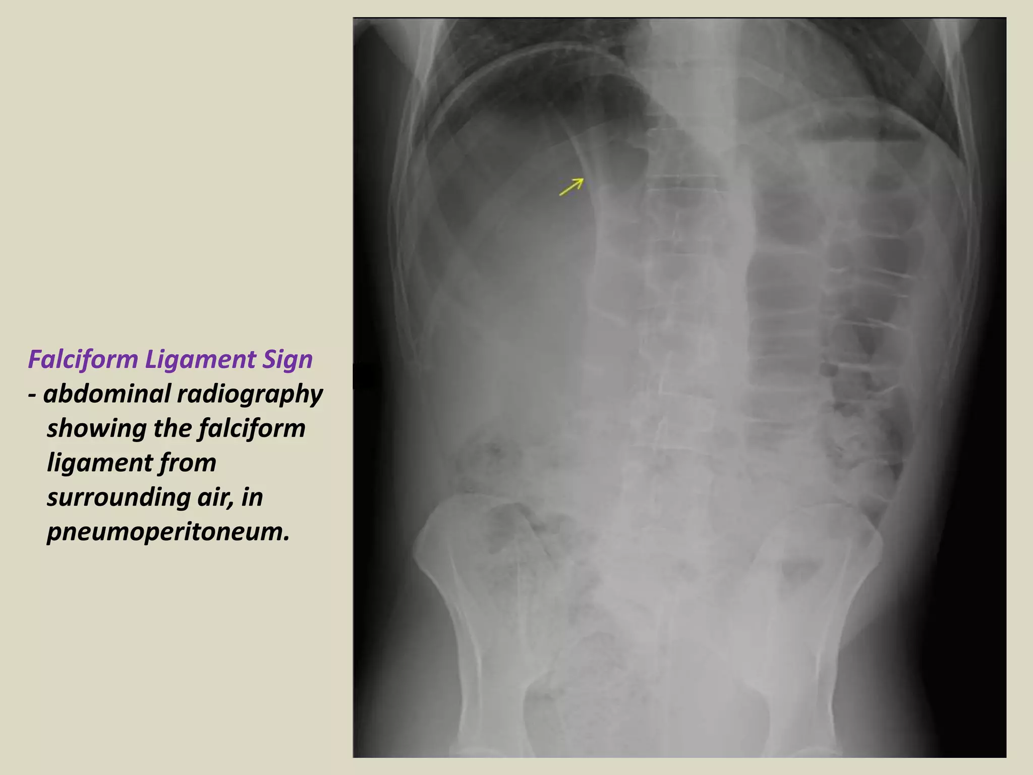 Presentation1, interpretation of x ray of the abdomen. | PPTX