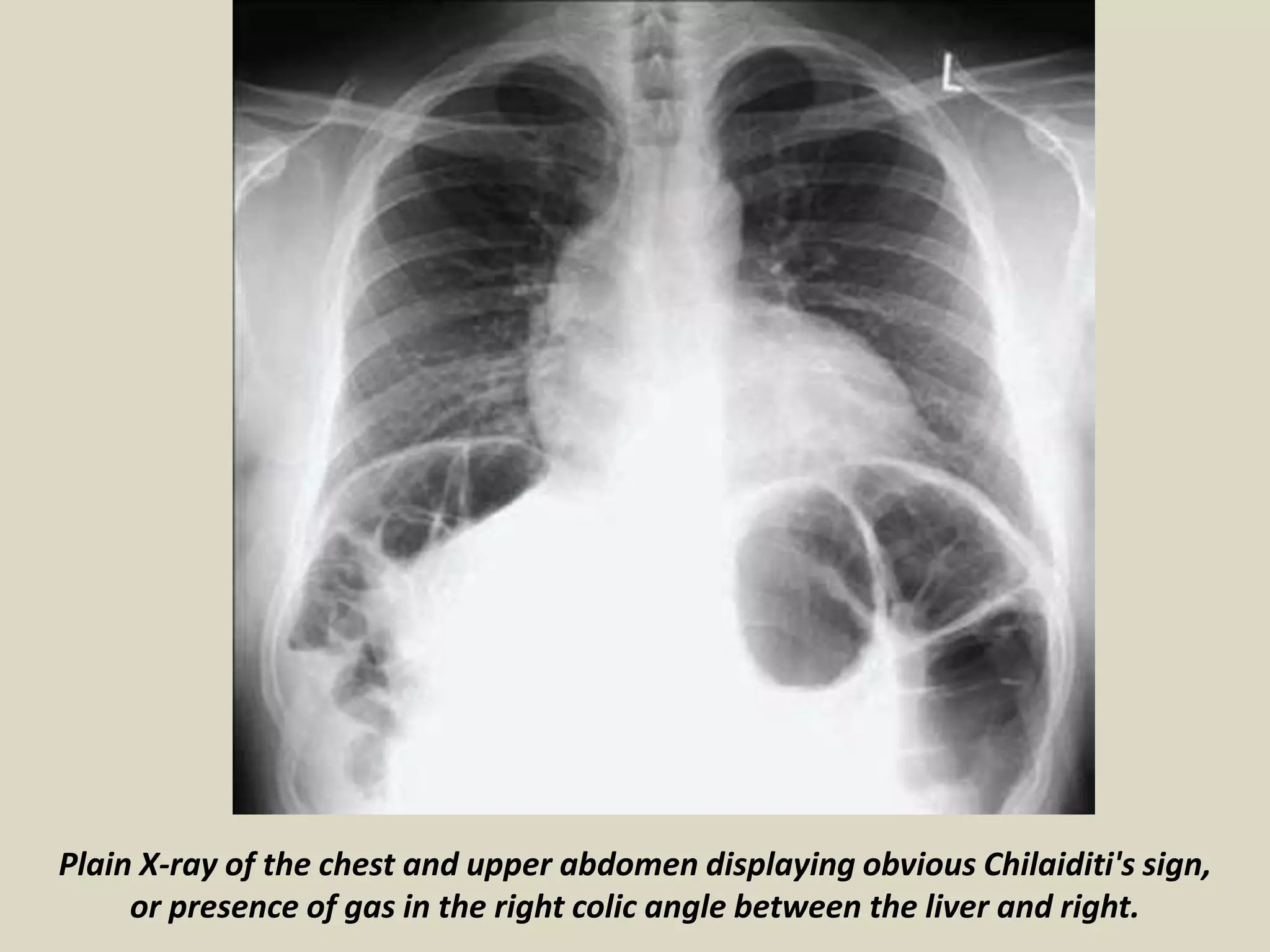 Presentation1, interpretation of x ray of the abdomen. | PPTX