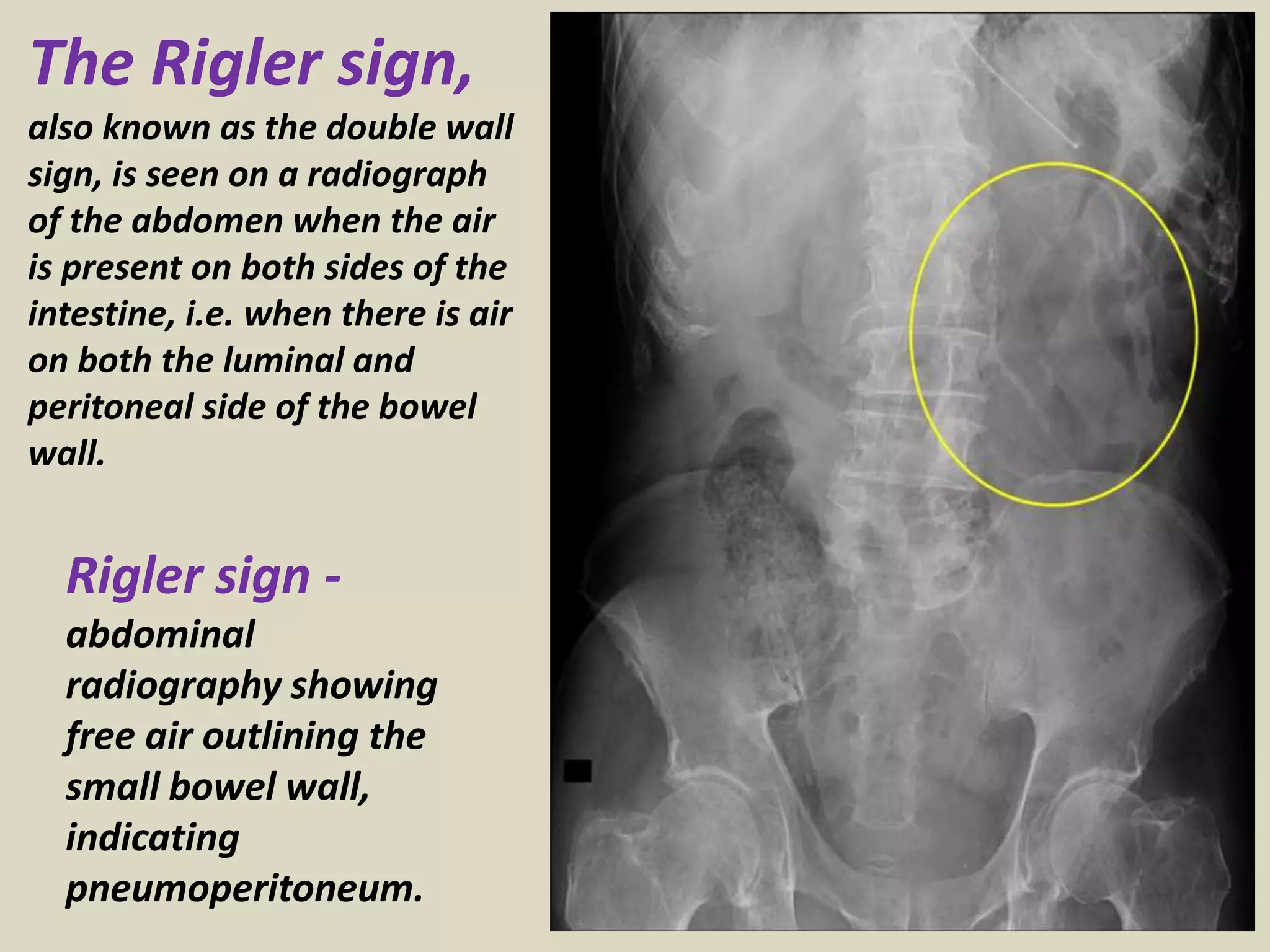 Presentation1, interpretation of x ray of the abdomen. | PPTX