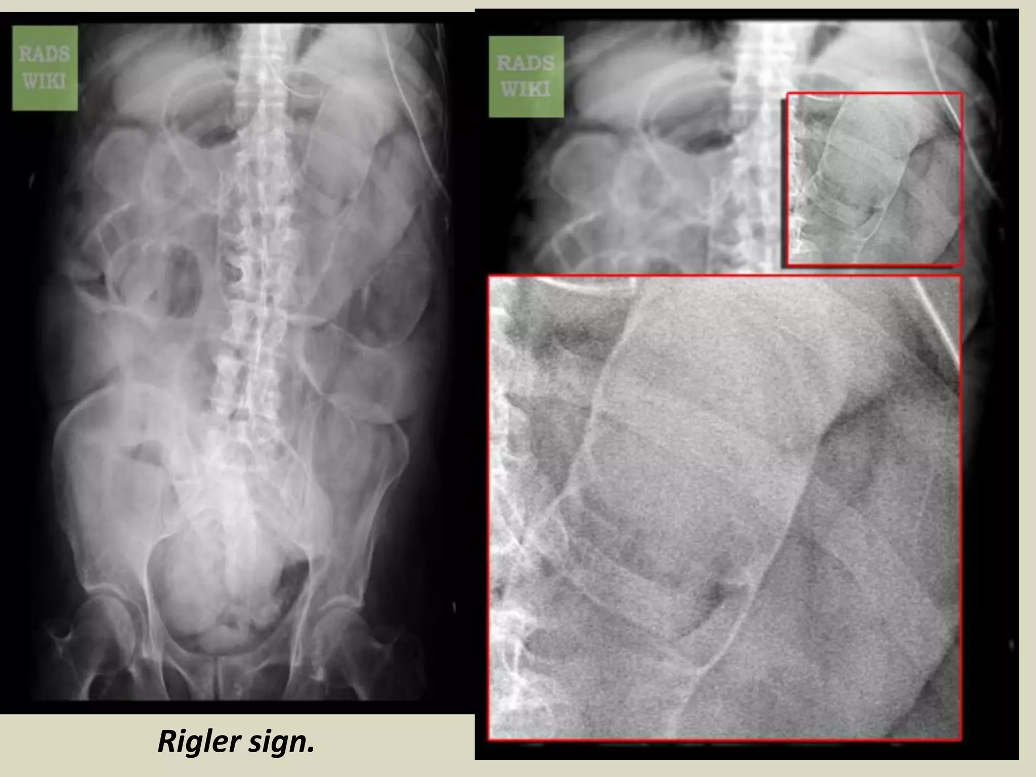 Presentation1, interpretation of x ray of the abdomen. | PPTX