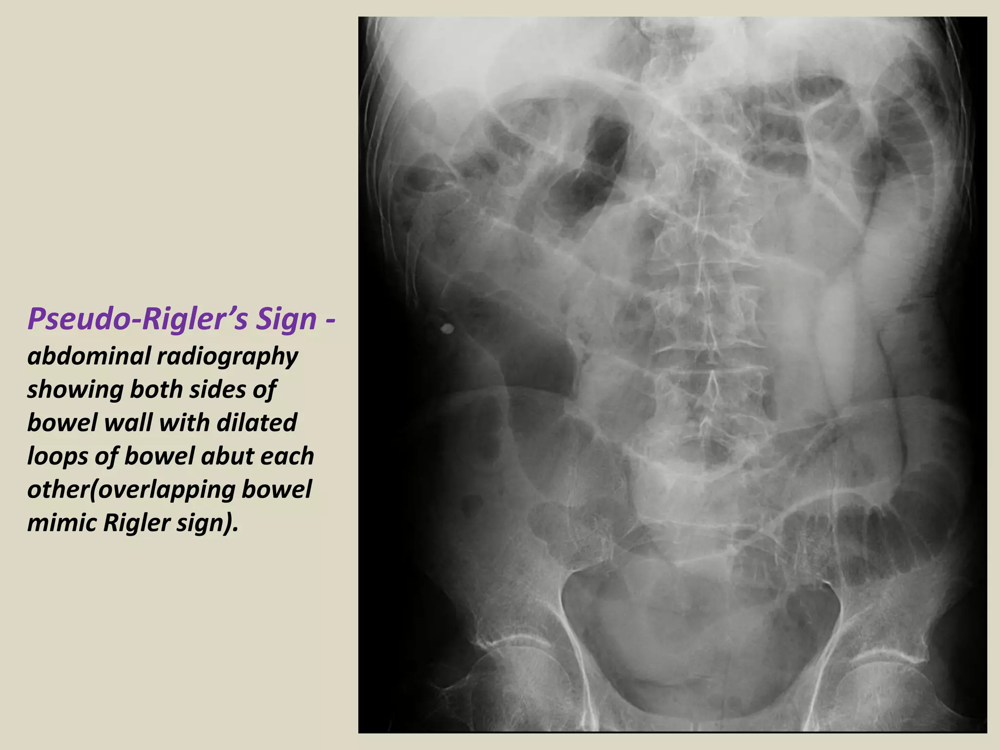Presentation1, interpretation of x ray of the abdomen. | PPTX