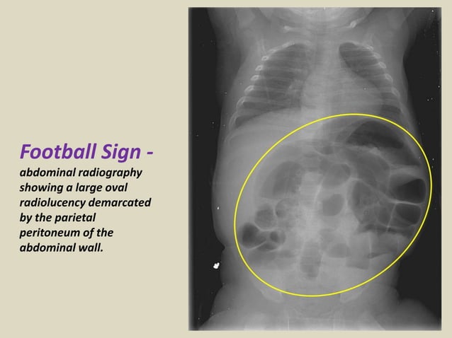 Presentation1, interpretation of x ray of the abdomen. | PPTX ...