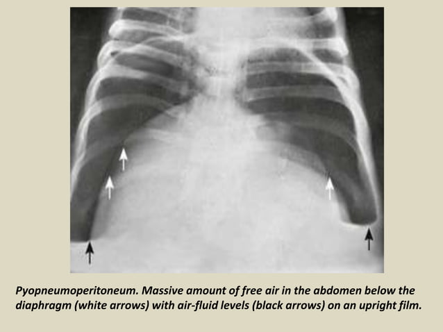 Presentation1, interpretation of x ray of the abdomen. | PPTX ...