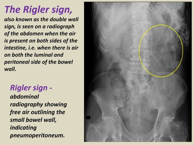 Presentation1, interpretation of x ray of the abdomen. | PPTX ...