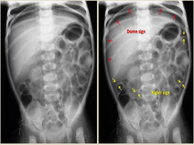 Presentation1, interpretation of x ray of the abdomen. | PPTX ...
