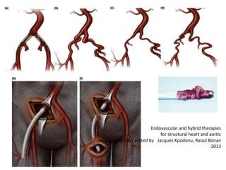 Hybrid Aortic Procedures | PPTX