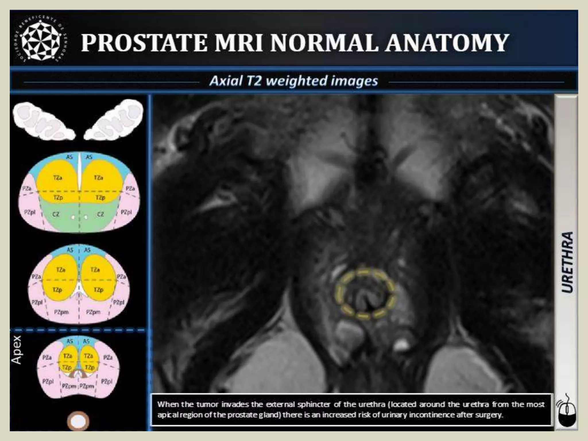 Presentation1, mri imaging of the prostate | PPTX