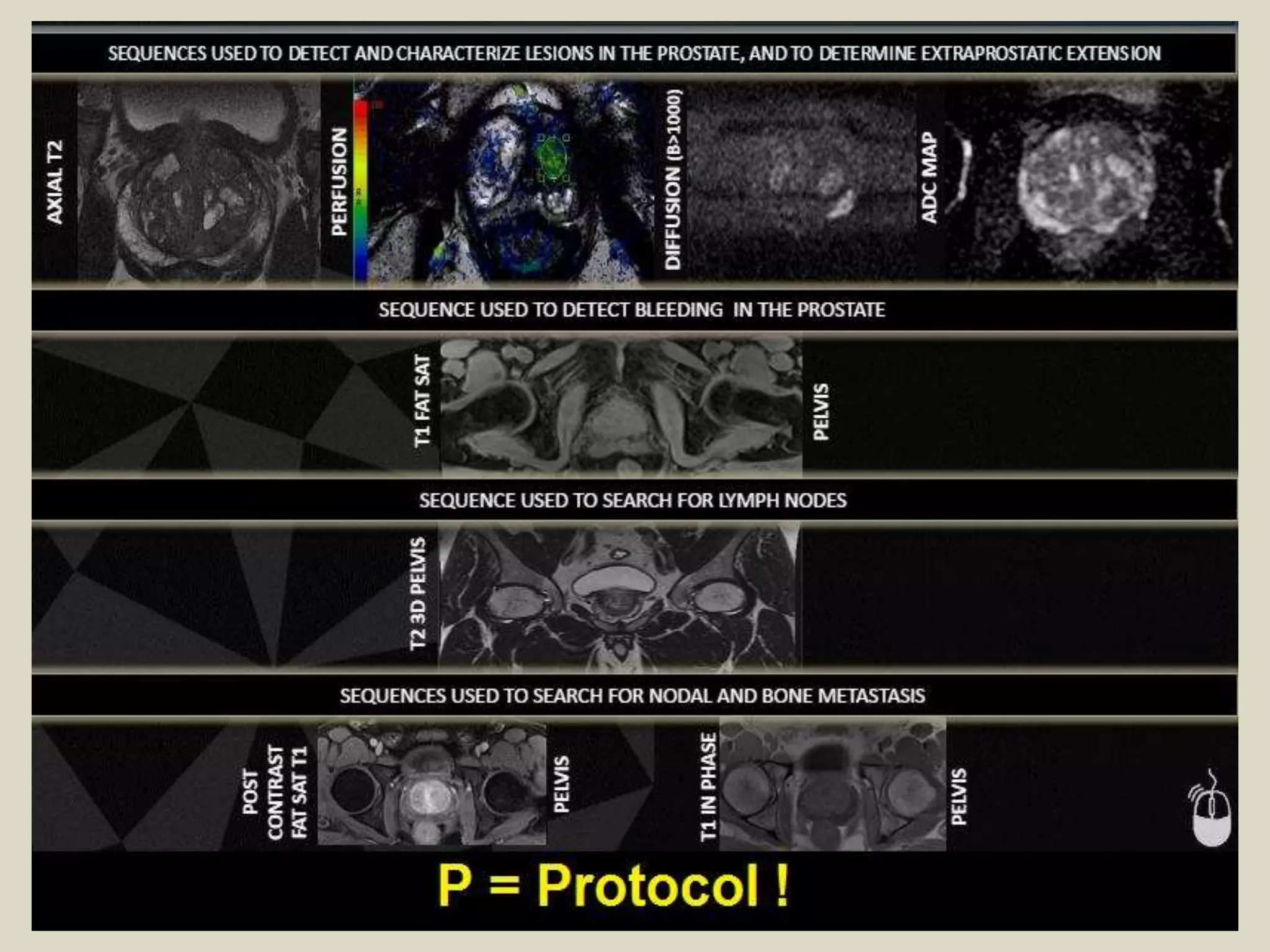Presentation1, mri imaging of the prostate | PPTX