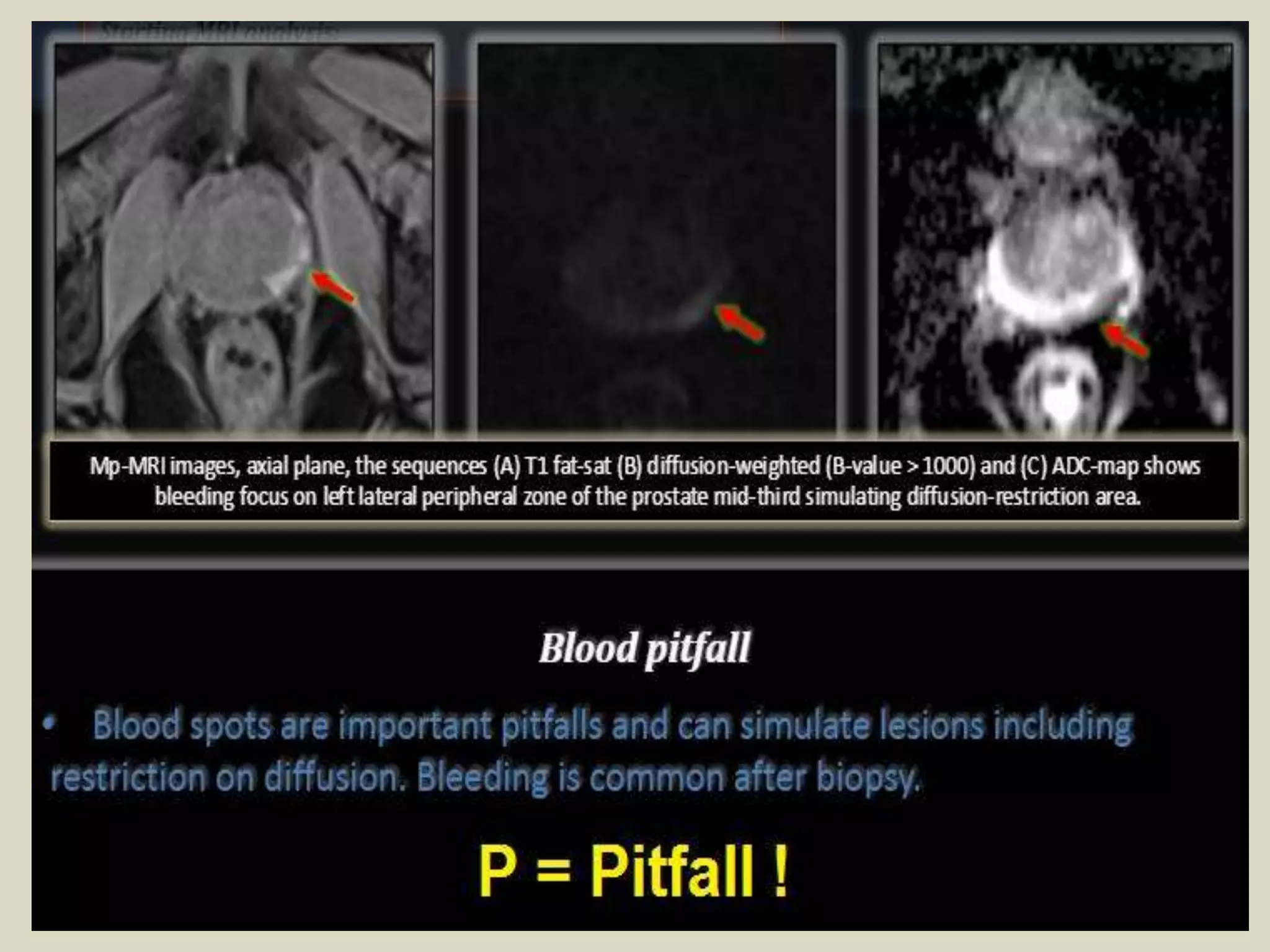 Presentation1, mri imaging of the prostate | PPTX