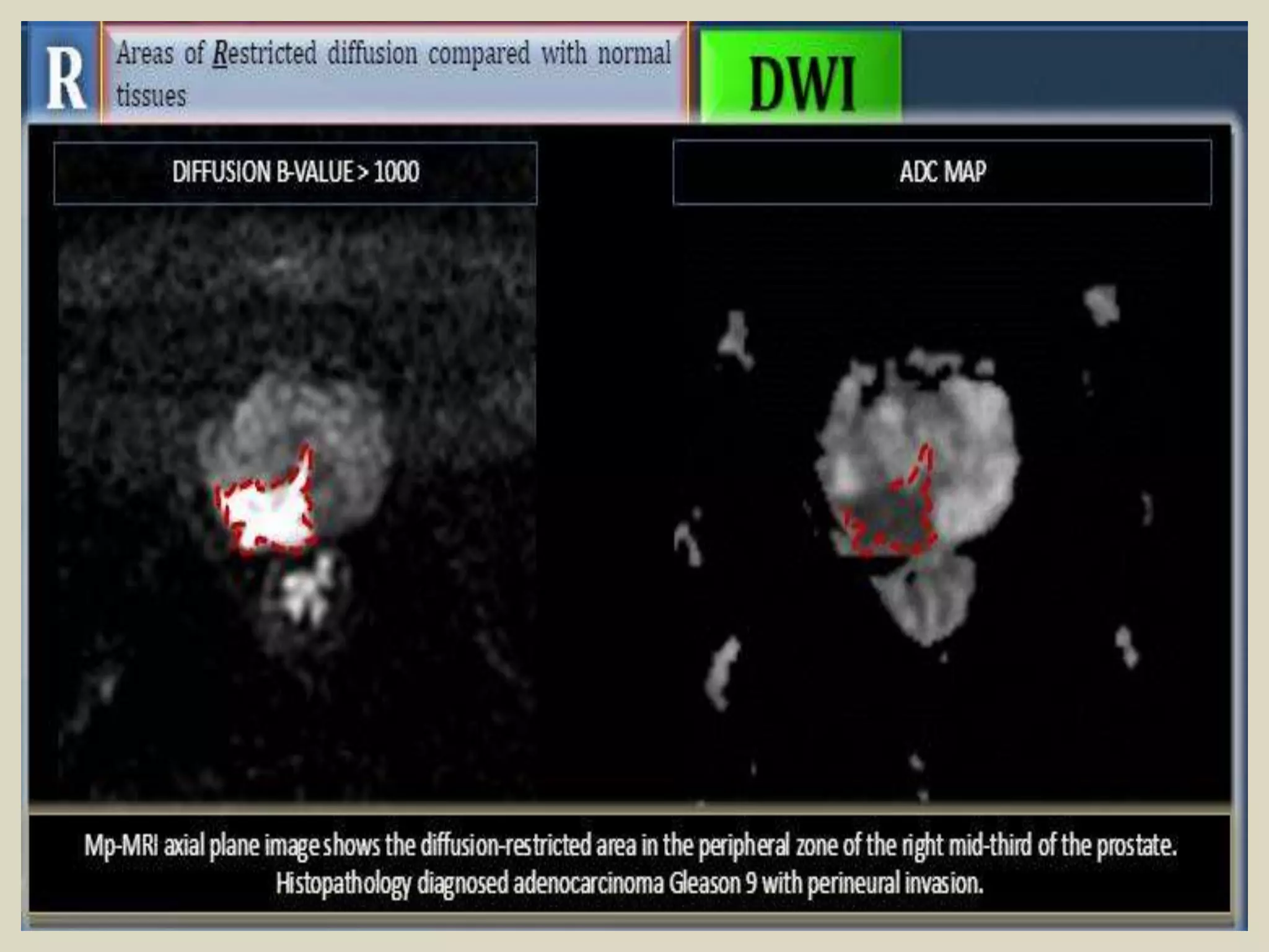 Presentation1, mri imaging of the prostate | PPTX