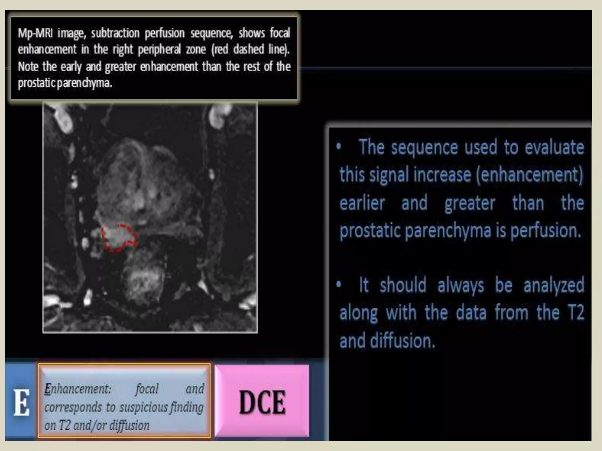 Presentation1, mri imaging of the prostate | PPTX