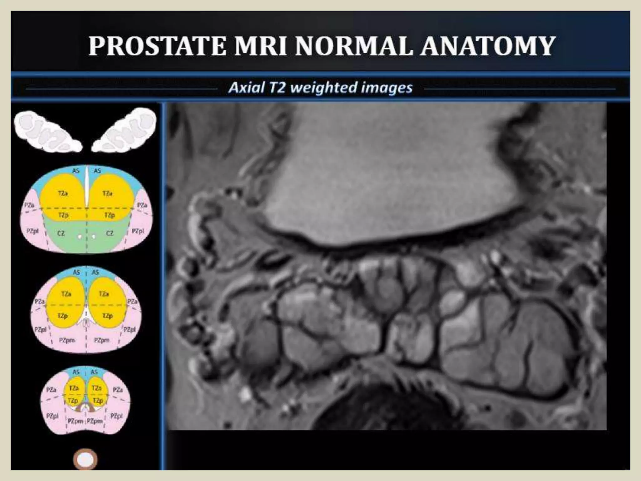 Presentation1, mri imaging of the prostate | PPTX