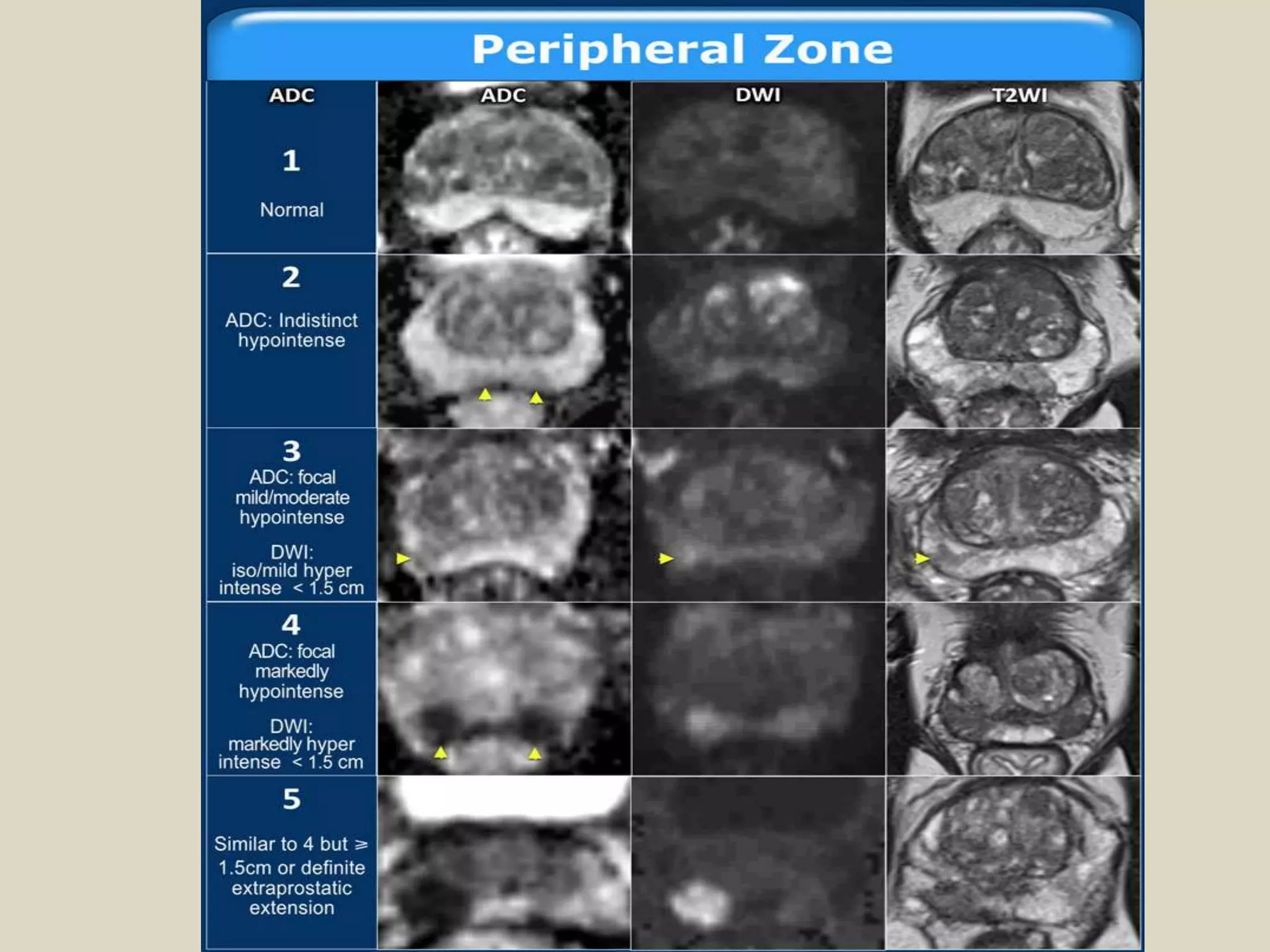 Presentation1, mri imaging of the prostate | PPTX