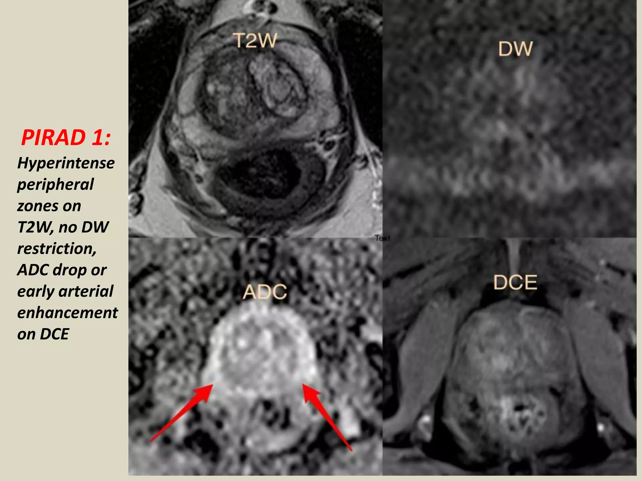 Presentation1, mri imaging of the prostate | PPTX