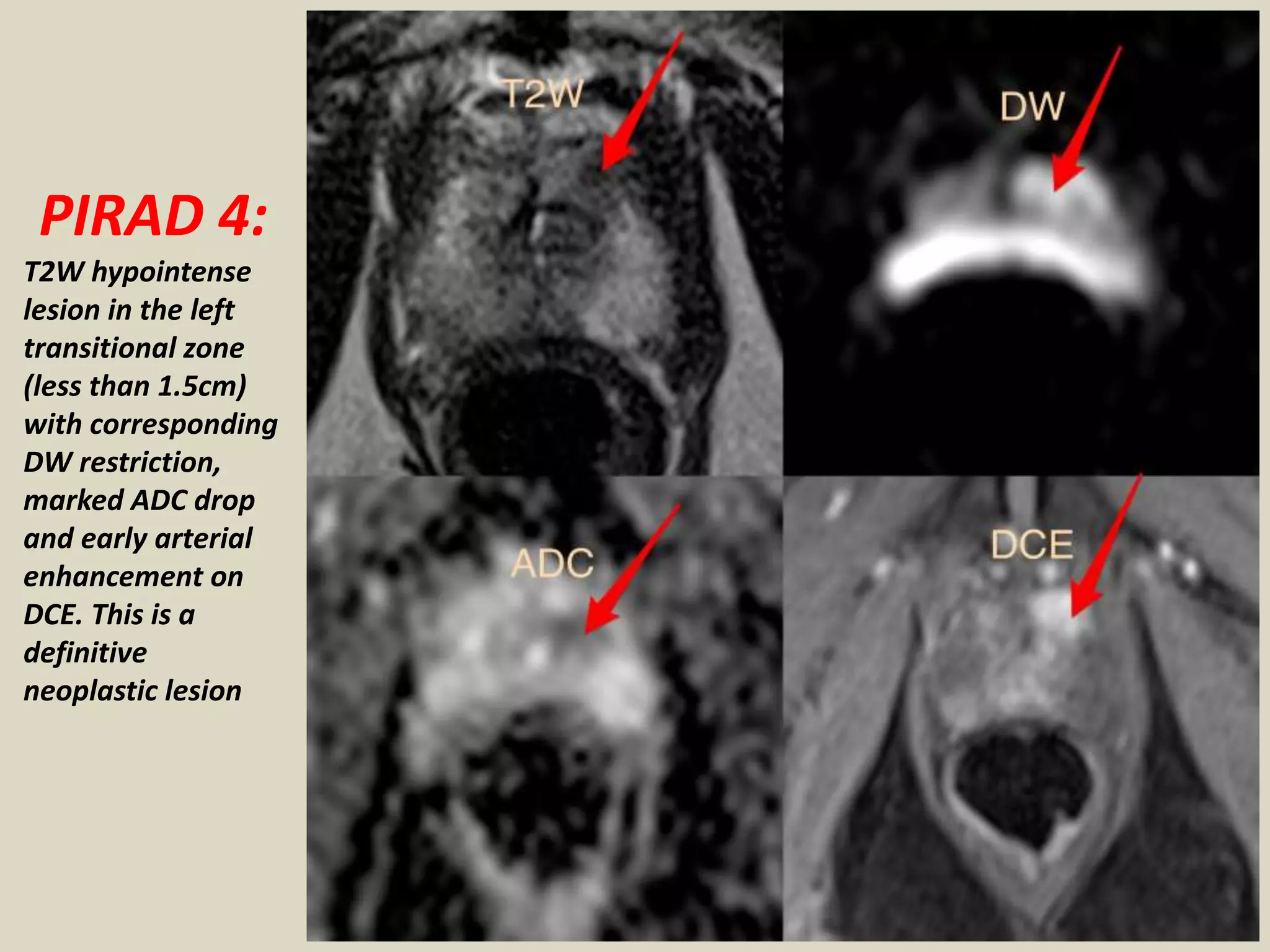 Presentation1, mri imaging of the prostate | PPTX