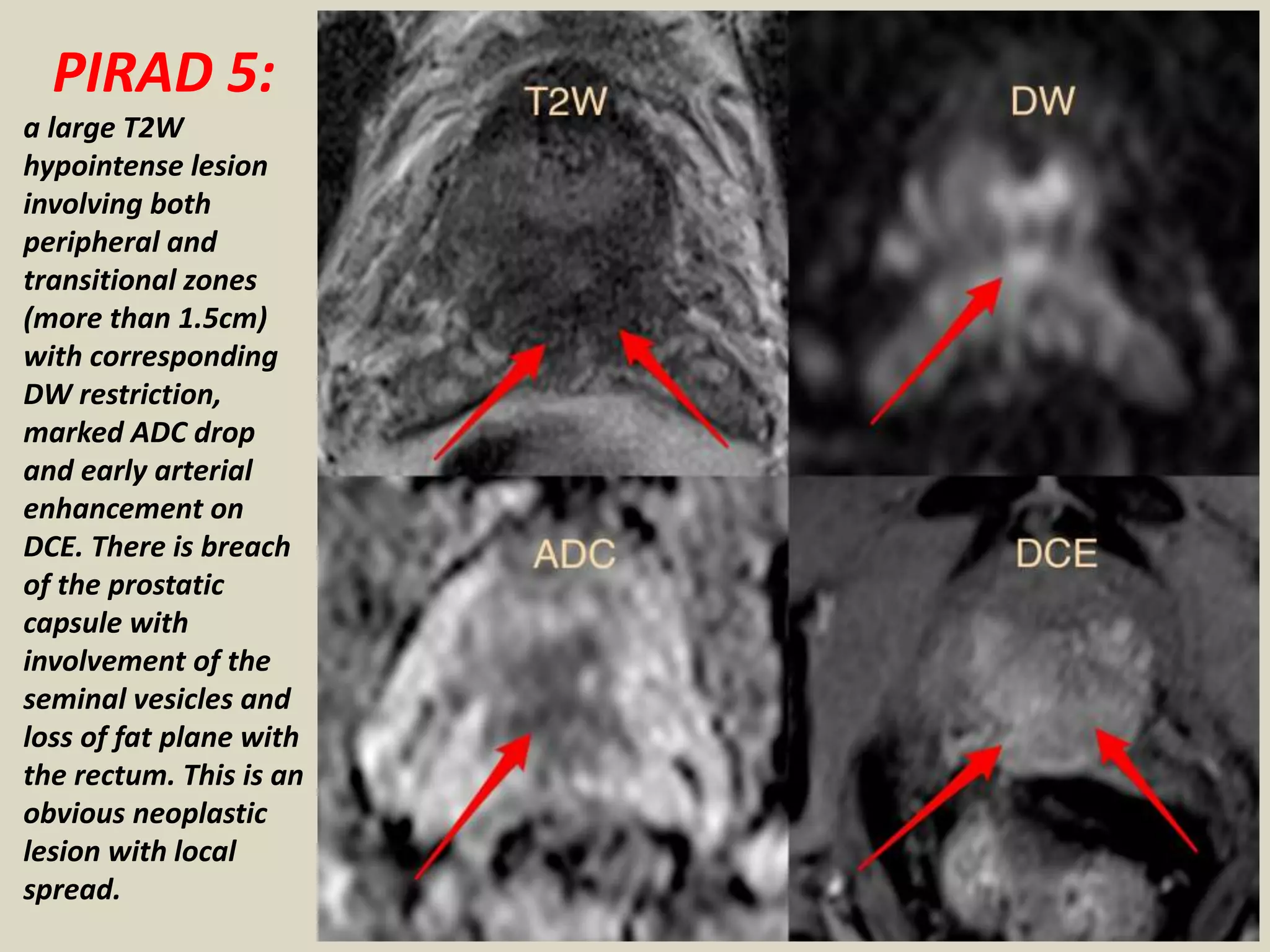 Presentation1, mri imaging of the prostate | PPTX