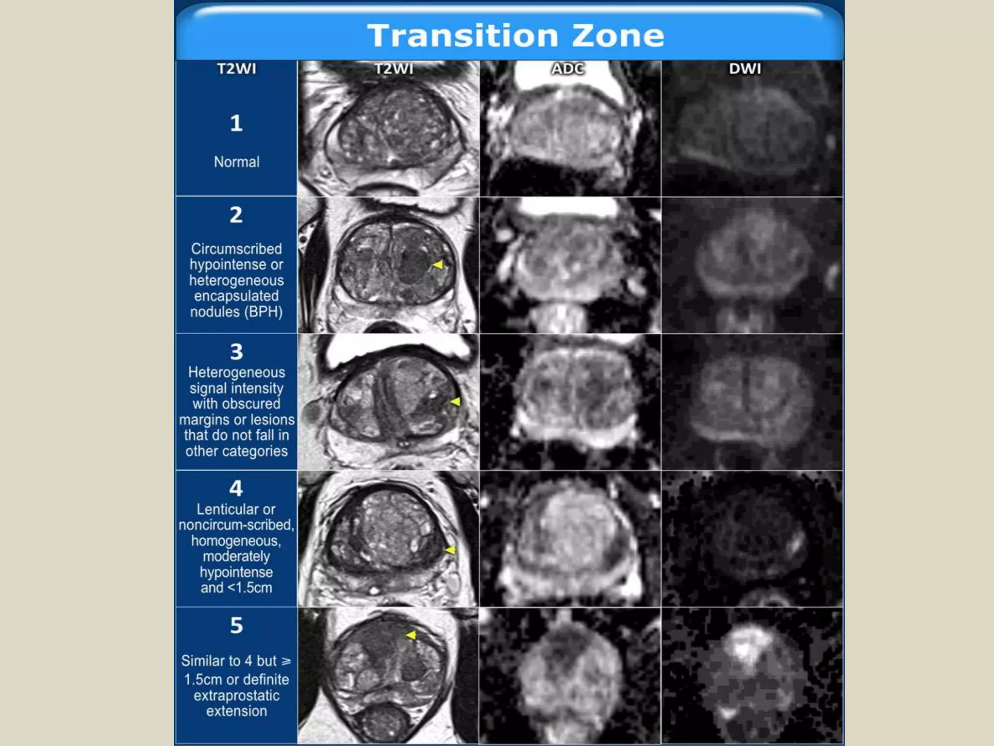 Presentation1, mri imaging of the prostate | PPTX