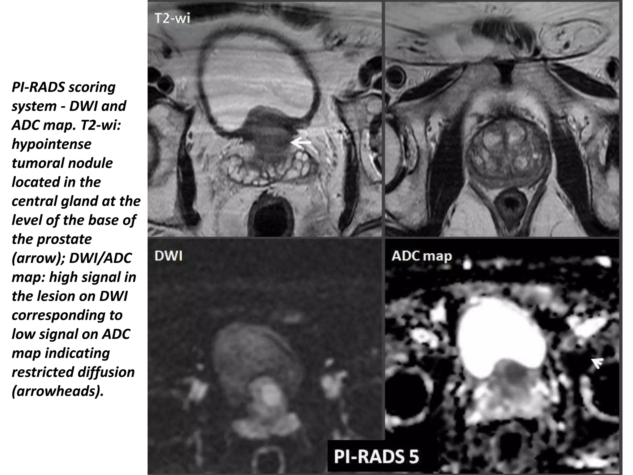 Presentation1, mri imaging of the prostate | PPTX