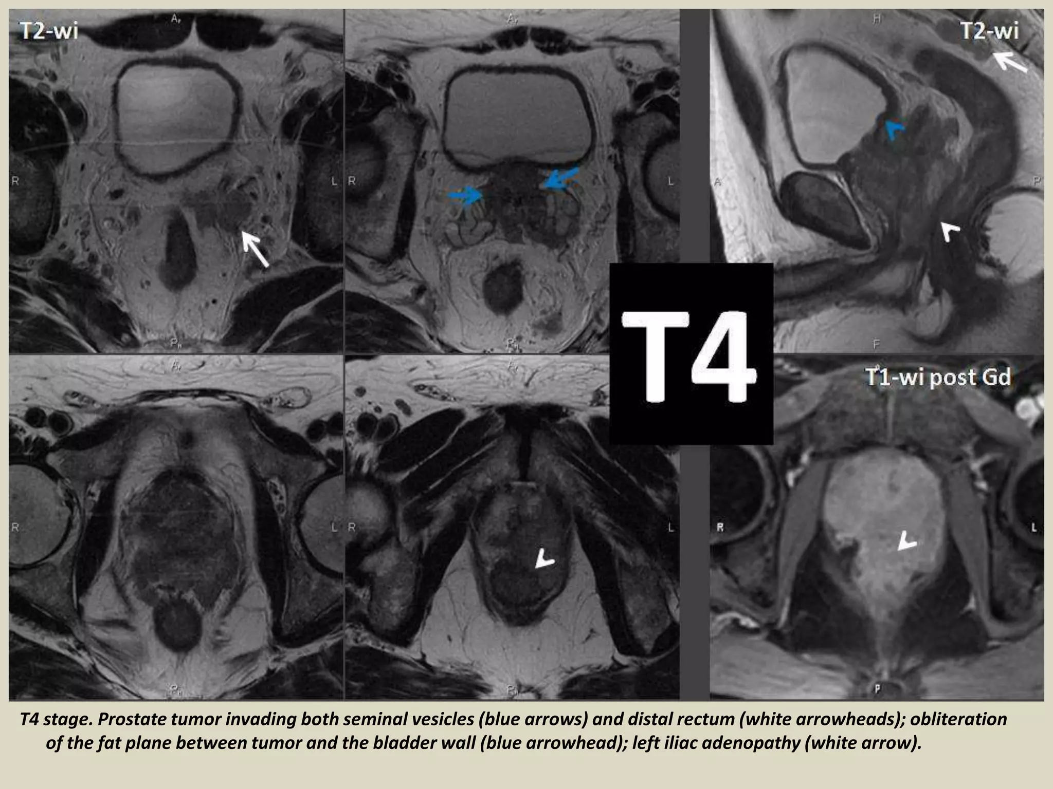 Presentation1, mri imaging of the prostate | PPTX