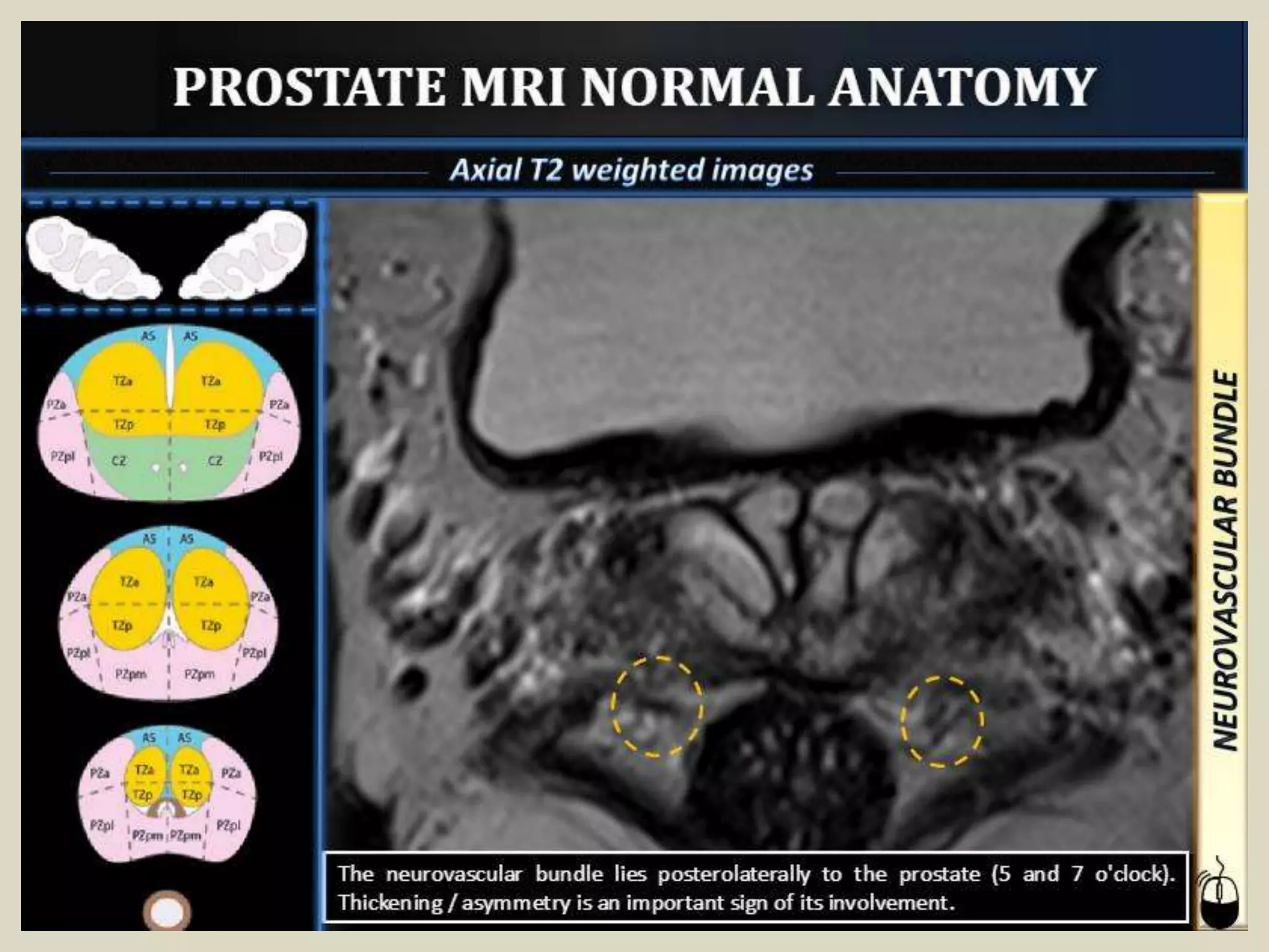 Presentation1, mri imaging of the prostate | PPTX