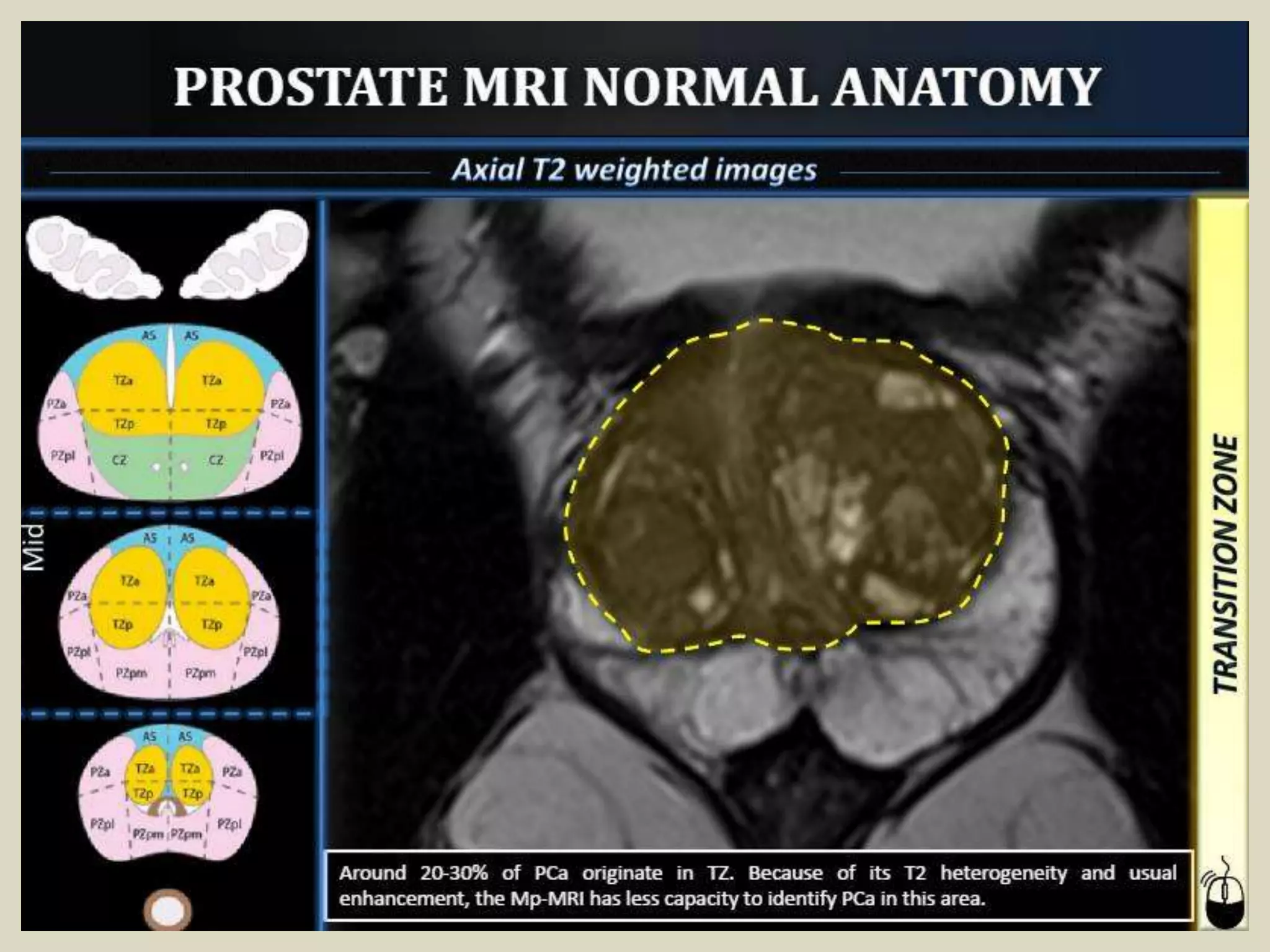Presentation1, mri imaging of the prostate | PPTX