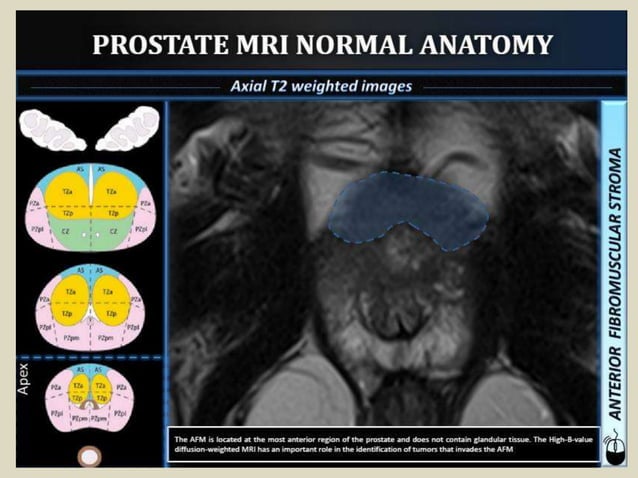 Presentation1, mri imaging of the prostate | PPTX
