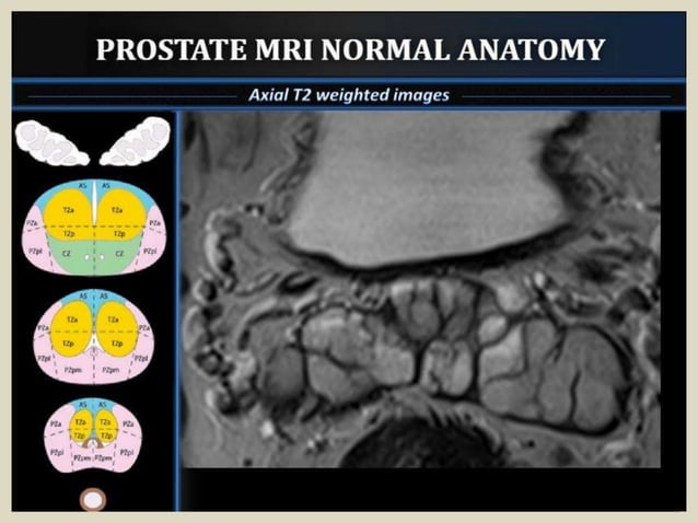 Presentation1, mri imaging of the prostate | PPTX