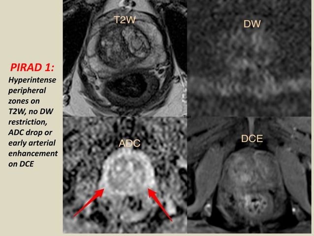 Presentation1, mri imaging of the prostate | PPTX