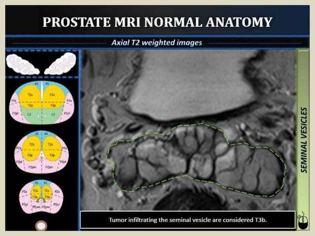 Presentation1, mri imaging of the prostate | PPTX