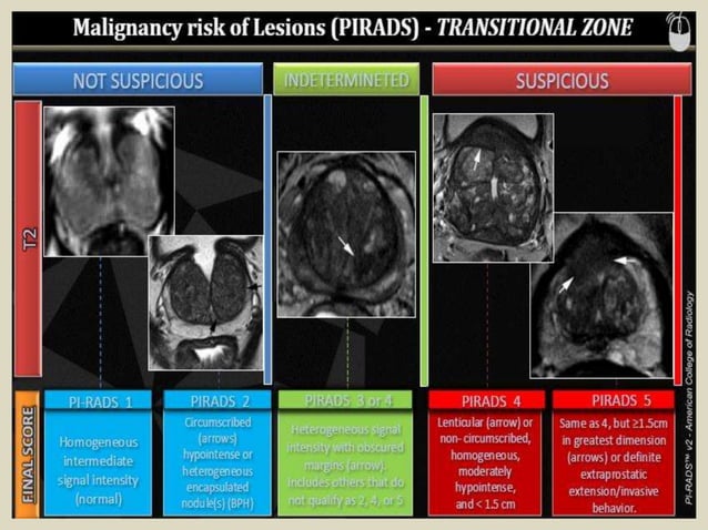 Presentation1, mri imaging of the prostate | PPTX