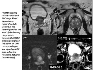 Presentation1, mri imaging of the prostate | PPTX