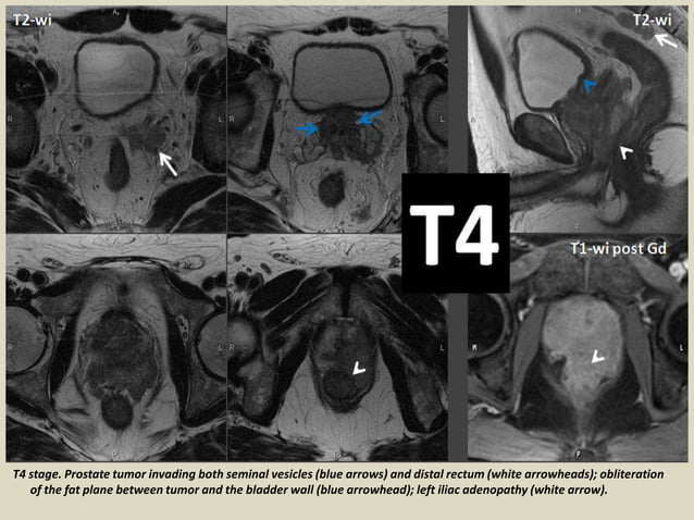 Presentation1, mri imaging of the prostate | PPTX