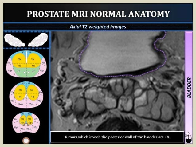 Presentation1, mri imaging of the prostate | PPTX