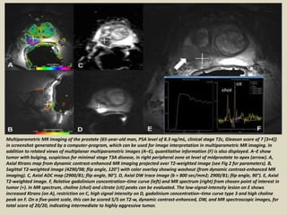 Presentation1, mri imaging of the prostate | PPTX