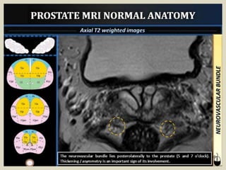 Presentation1, mri imaging of the prostate | PPTX