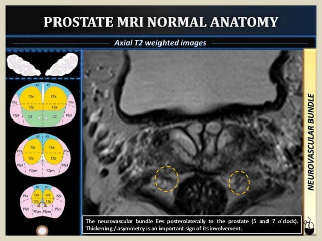 Presentation1, mri imaging of the prostate | PPTX
