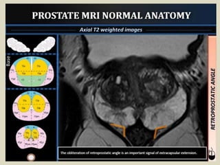Prostate Gland Anatomy Mri