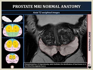Prostate Gland Anatomy Mri
