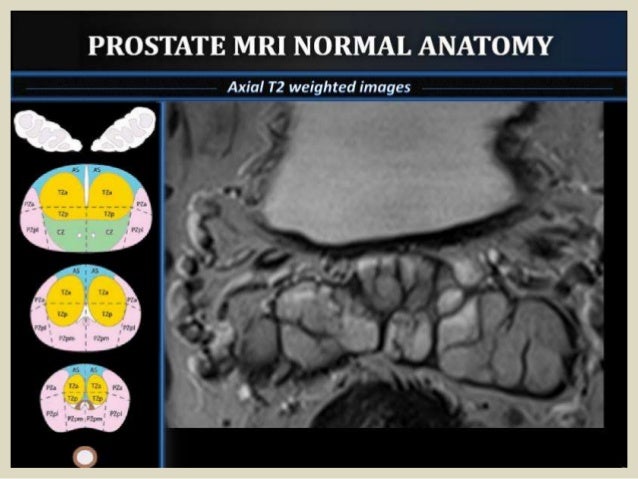 Presentation1 Mri Imaging Of The Prostate