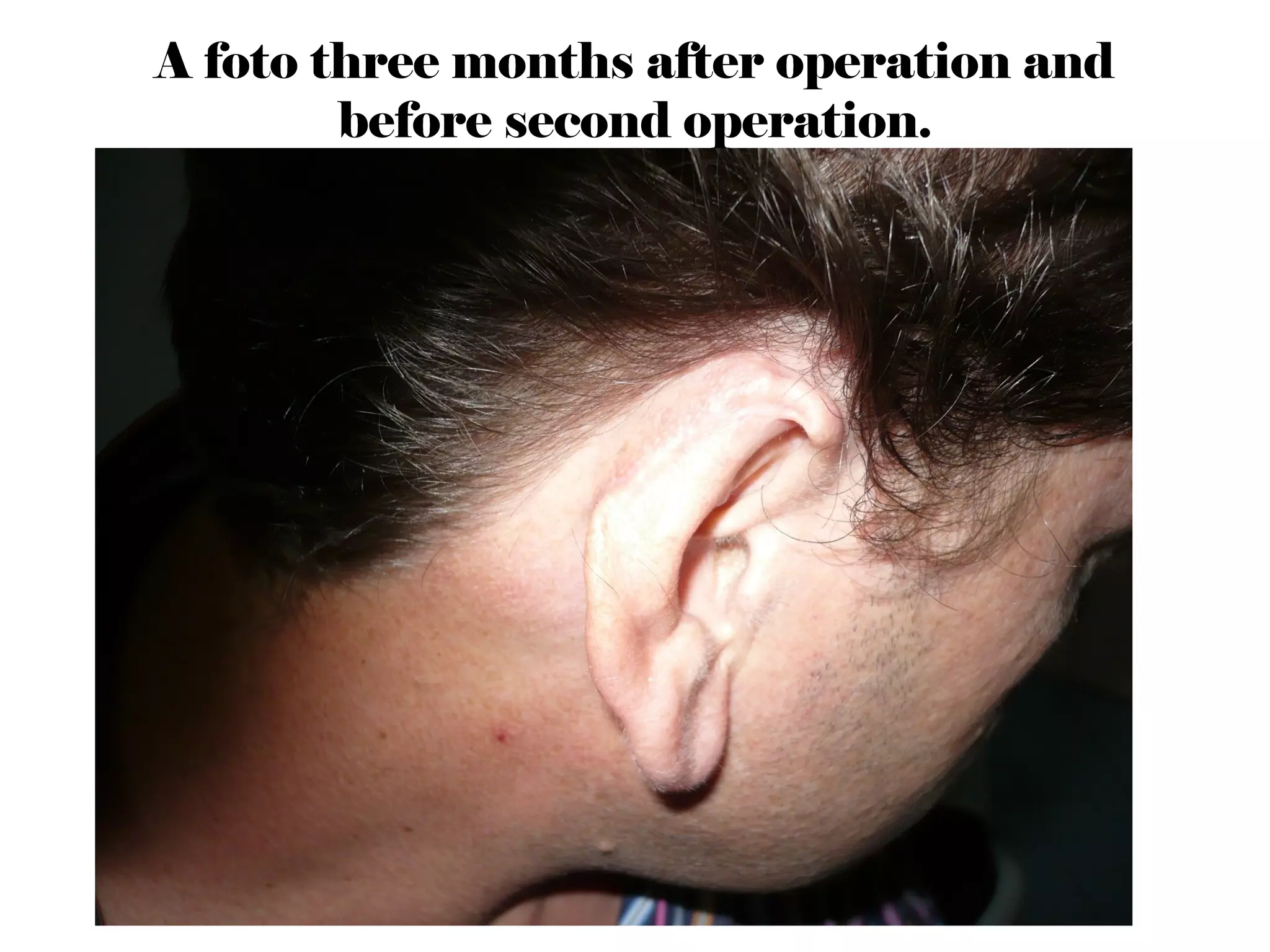 Septal cartilage for repairing partial defect of auricule. | PPT