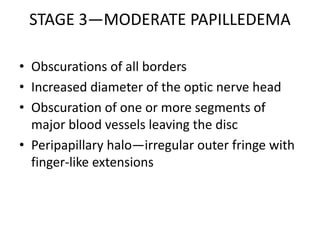 Presentation1 pseudotumor | PPTX