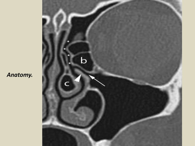 Presentation1, quiz for the petrous bone and para nasal sinuses. | PPTX