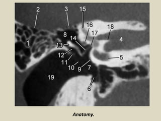 Presentation1, quiz for the petrous bone and para nasal sinuses. | PPTX